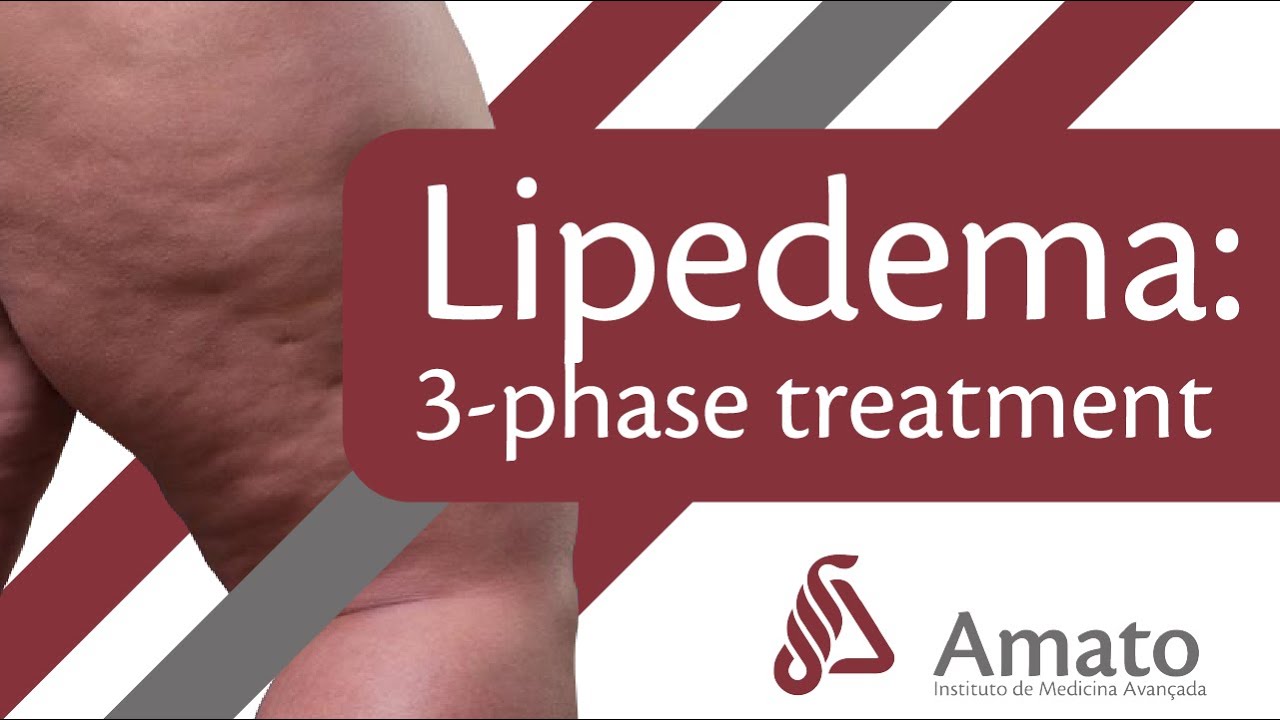 Lipedema Disease: three-phase treatment (English subs) - ABL